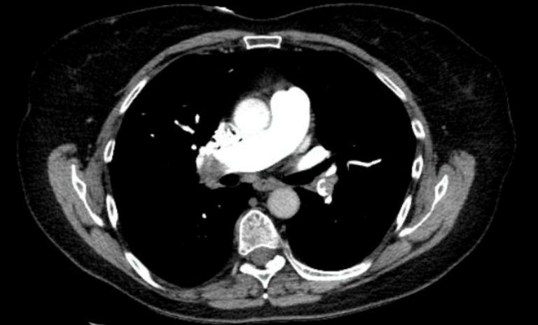 Pulmonary Thromboembolism – Undergraduate Diagnostic Imaging Fundamentals