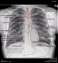 Chest – Undergraduate Diagnostic Imaging Fundamentals